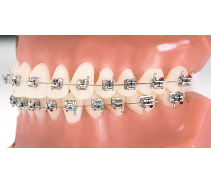 Brackets de Autoligado